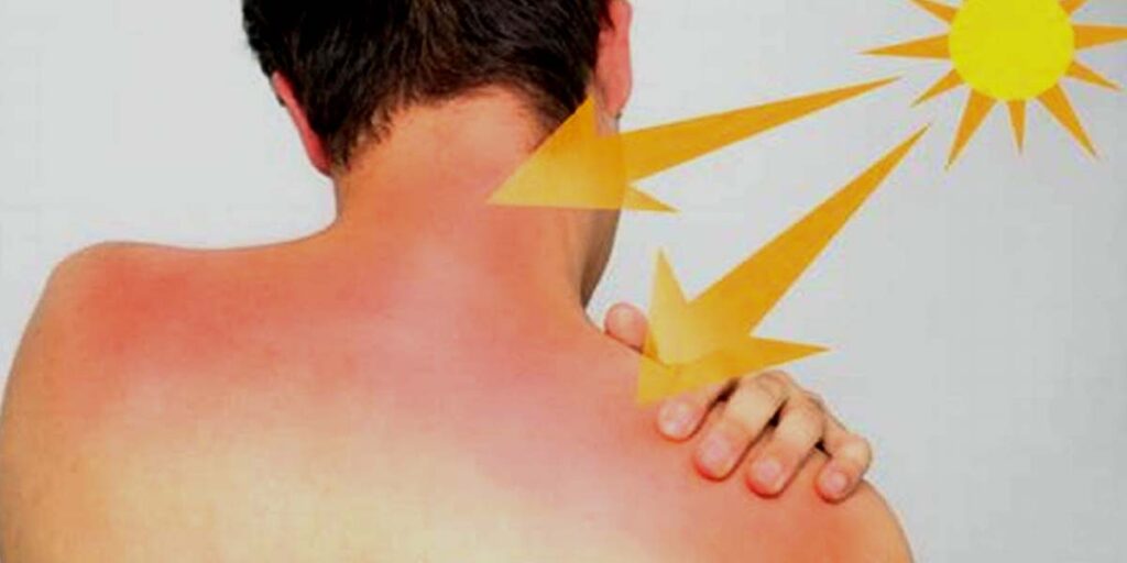 Why Does Sunburn Cause Death? The Hidden Risks | ARZPAK